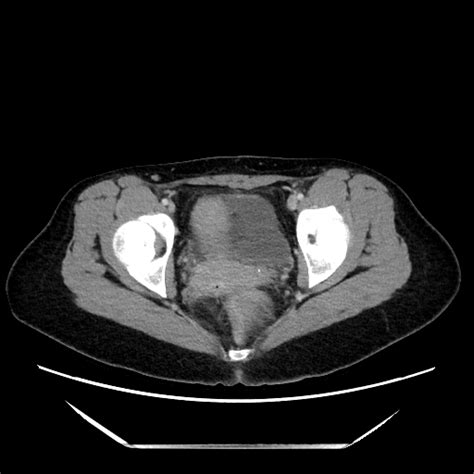 File Crohns Disease Terminal Ileitis Fistulizing Radiopaedia 98245 118784 Axial 151 Jpeg