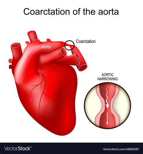 Aortic Coarctations Congenital Heart Defect Vector Image