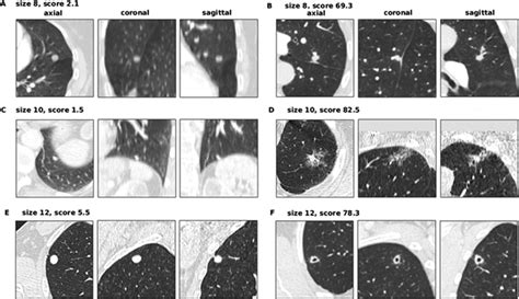 External Validation Of A Convolutional Neural Network Artificial Intelligence Tool To Predict