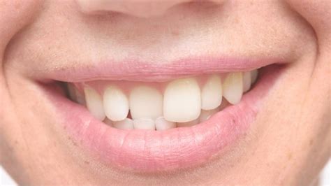 How To Fix A Snaggletooth Causes Problems And Treatments