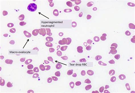 Ovalocyte