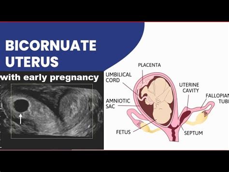 Bicornuate Uterus Causes Symptoms Ultrasound Müllerian Anomalies