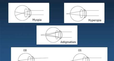 Uncorrected Refractive Errors Leading Cause Of Visual Impairment