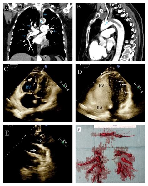 A Computed Tomography Pulmonary Angiogram Frontal Reconstruction Download Scientific Diagram