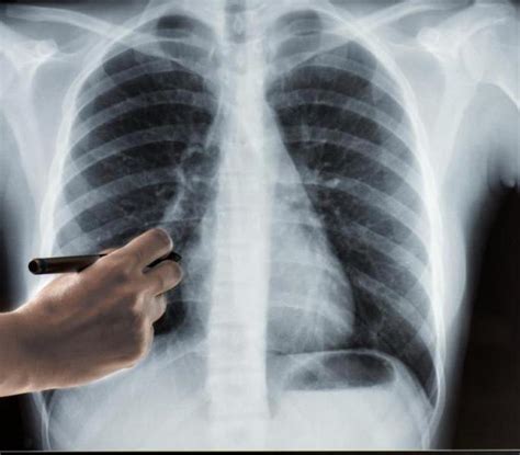 Перелом консолидированный ребра Консолидированный перелом что это такое мкб 10