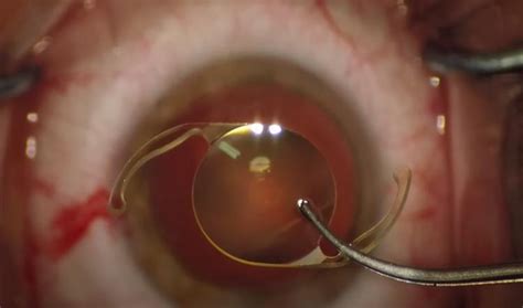 What Are Vivity Lenses Uses And Benefits