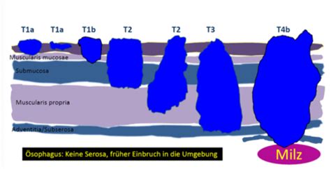 11 Gi Trakt Karteikarten Quizlet