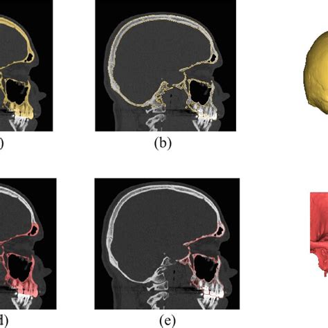 A Mask Segmentation Of Upper Skull B Bone Contour Of Upper Skull