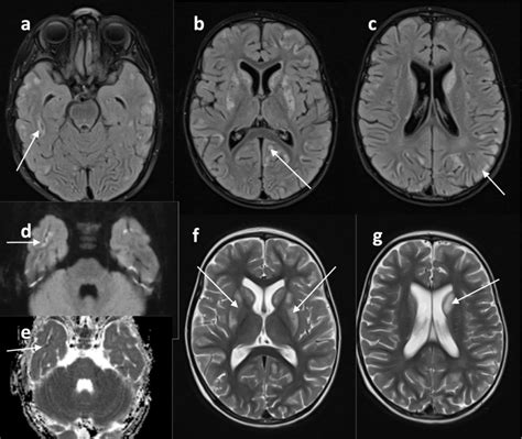 Patient 2 At The Age Of 2 5 Years Mr Brain Imaging Axial Flair A B Download Scientific