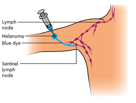 Why Remove Lymph Nodes Why Remove Lymph Nodes