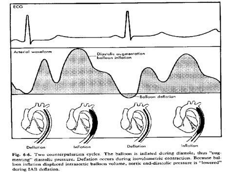 Iabp Principle Hemodynamic Timing Weaning 2016 Background Asmiha Isman Edit Pptx