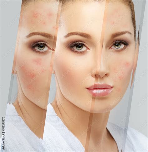 Acne Skin Concern Blemish Prone Skin And Acne Rosacea Different Types Of Acne Stock Photo