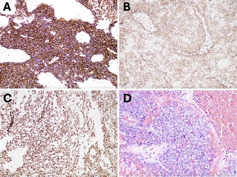 Ewing Sarcoma Extraosseous Brain Metastasis Presenting With An