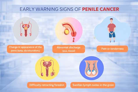 Penile Cancer St Stamford Modern Cancer Hospital Guangzhou