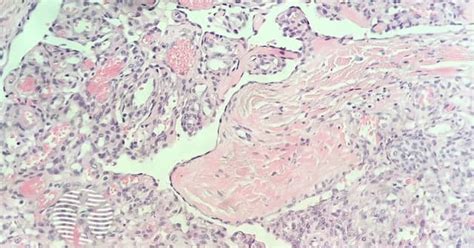 Glomeruloid Hemangioma Pathology Image