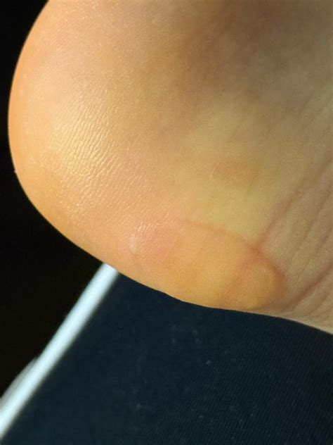 발 뒤꿈치에 물집이 생겼는데 어떡하죠 지식in