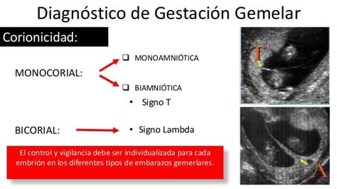 Ecografia Del Primer Trimestre