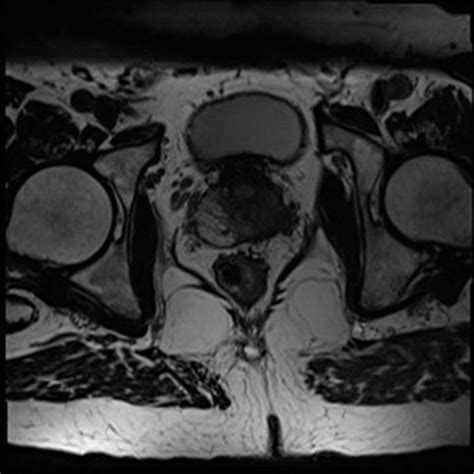 Prostate Cancer With Extracapsular Extension Body Mr Radiology Case