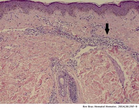 Bleomycin Induced Flagellate Dermatitis Hematology Transfusion And Cell Therapy