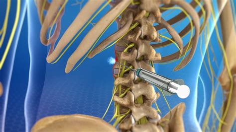 Sympathetic Nerve Block Sound Pain Alliance Our Treatments