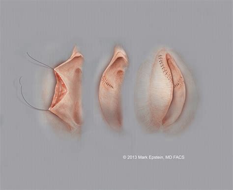 Labiaplasty Wedge
