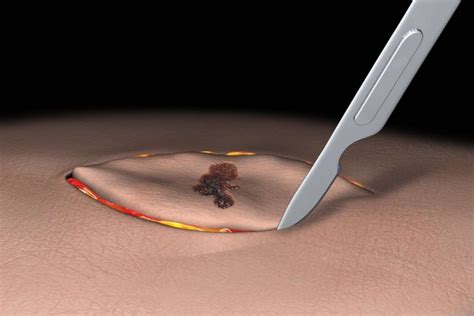 Soft Tissue Biopsy Procedure Types And What To Expect The