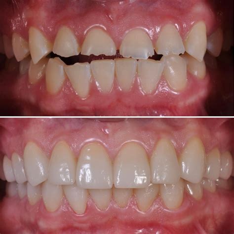 Dental Reconstruction Explained Transcend Dentistry