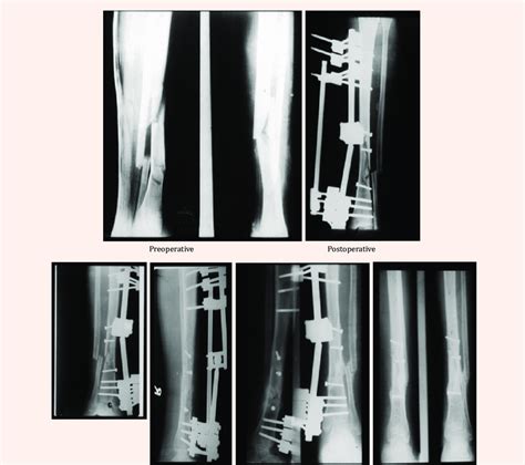 Case 1 Displaced Lower 13rd Segmental Tibial Shaft Fracture