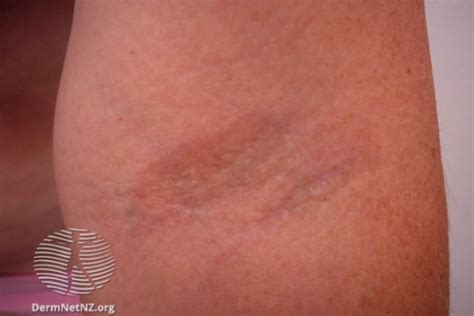 Crest Scleroderma Scalp