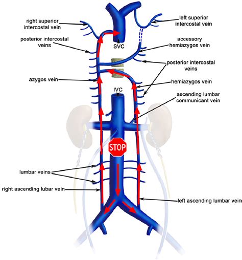 Figure From Congenital Inferior Vena Cava Agenesis With Ulceration