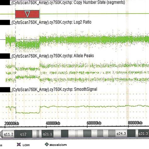 Chromosomal Microarray Data From The Patient Showing The Chromosome Download Scientific Diagram