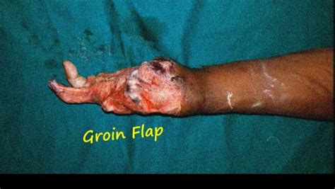 Groin Flap For Hand Defect Operative Video Guide With Step By Step