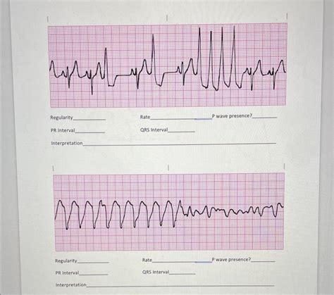 Solved Regularity Rate P Wave Presence Pr Interval Qrs