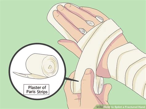 4 Ways To Splint A Fractured Hand Wikihow