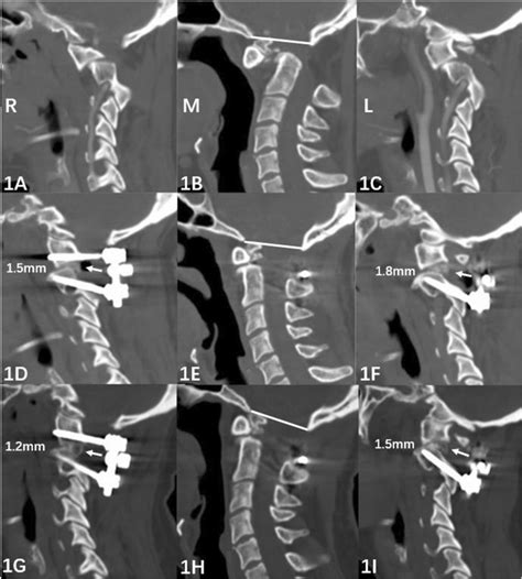 An Atlantoaxial Dislocation Without BI Managed With Posterior Download Scientific Diagram