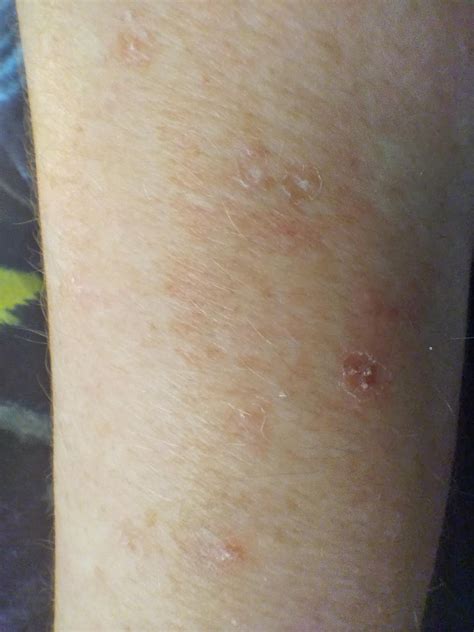 small patches of dry scaly skin on arms and a few on legs. roundish in shape, indented, with ...