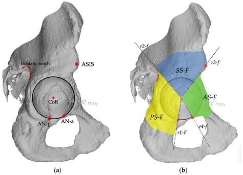 Quantitative Assessment Of Acetabular Defects In Revision Hip Arthroplasty Based On 3d Modeling