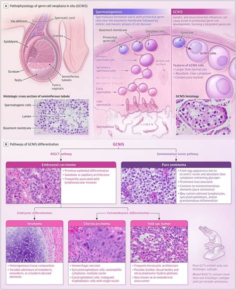 Testicular Cancer Is The Most Common Solid Malignancy In Young Men