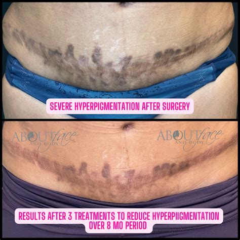 Will Tummy Tuck Scars Go Away Effective Strategies To Reduce Scarring