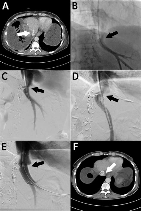 58 Year Old Male Patient No 5 Presenting With Hepatic Venous