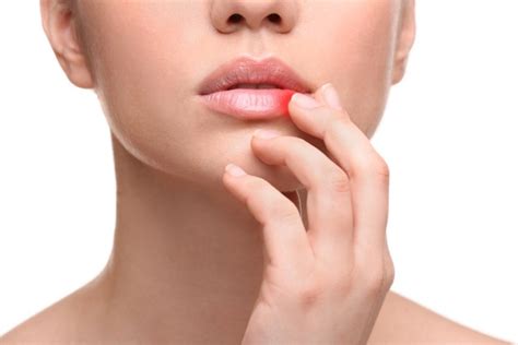 Cold Sores All Skin Problems Expert Skin Care Tips Treatments