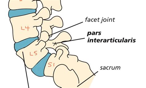 Pars Fracture Spondylolysis Meet Dr Joel Edionwe