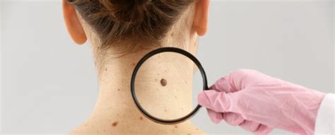 Recognizing The Early Warning Signs Of Melanoma