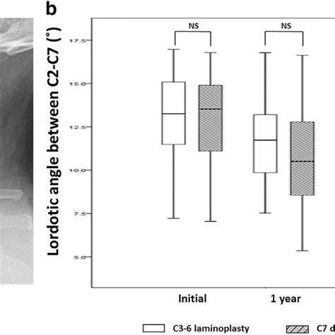 C7 Dome Like Laminectomy A Dome Like Grooves Are Drilled With A