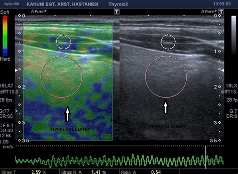 Elastogram Of A Healthy Control Group Patient The Grayscale Image Is