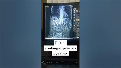A T Tube Cholangiogram X Ray Youtube