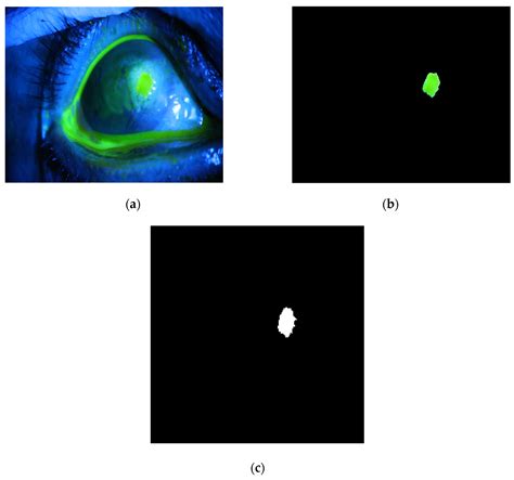 Automated Detection Of Corneal Ulcer Using Combination Image Processing