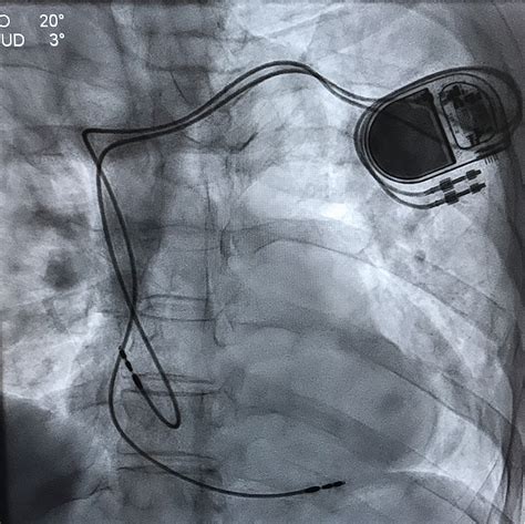 Twiddlers Syndrome An Uncommon And Dangerous Cause Of Pacemaker