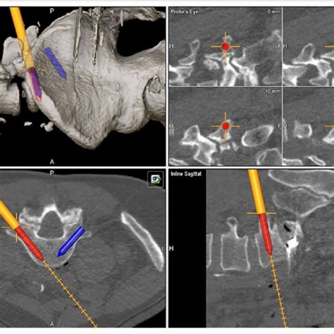 Example Of Intraoperative Computed Tomography Ict 3 Dimensional