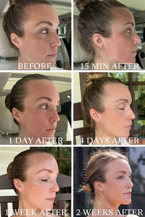 My Moxi Laser Treatment Review With Before And Afters Natalie Yerger